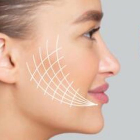 Thread Lift (PDO Threads) | Aesthetics | Bethcar